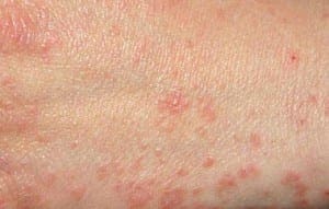 scabies | Sanova Dermatology