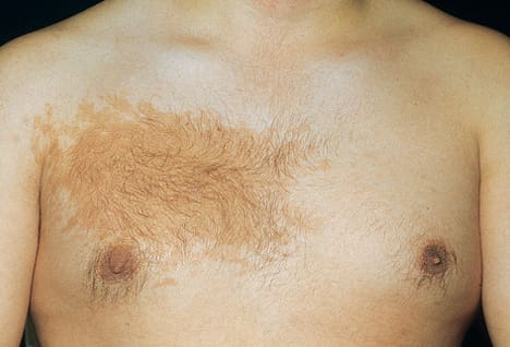 beckers-nevus | Sanova Dermatology