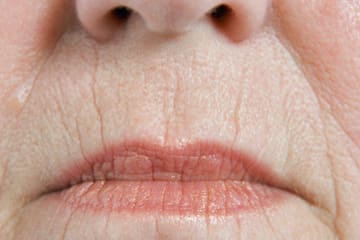 Botox For Vertical Lip Lines
