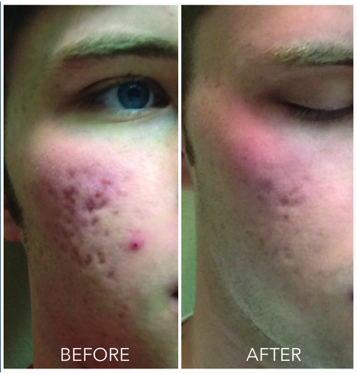 Micro-needling Can Treat Acne Scars