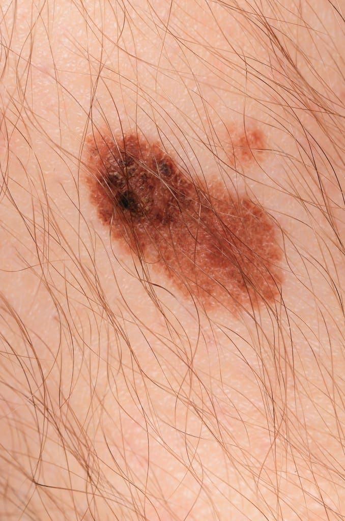 Do I Have Precancer On My Skin?