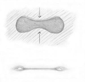 What is a dog ear in skin surgery?