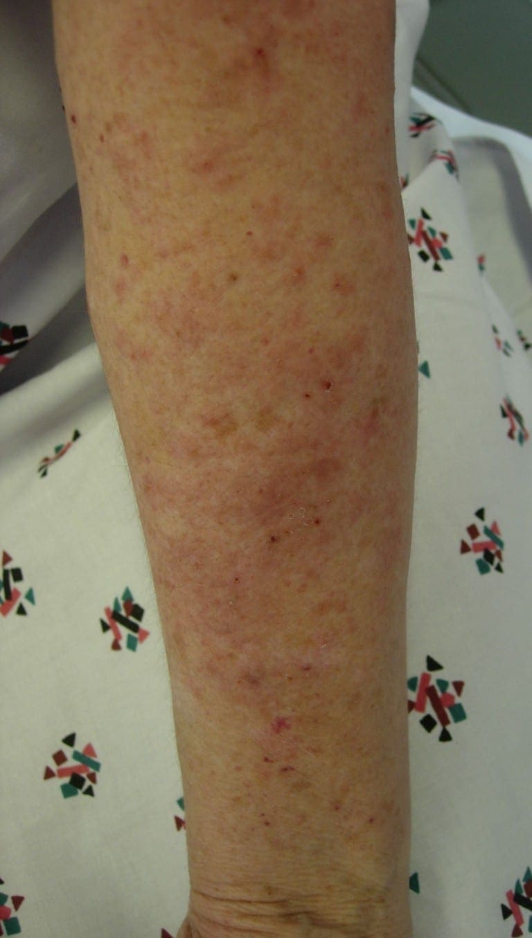 Atopic Dermatitis Presentation and Treatments
