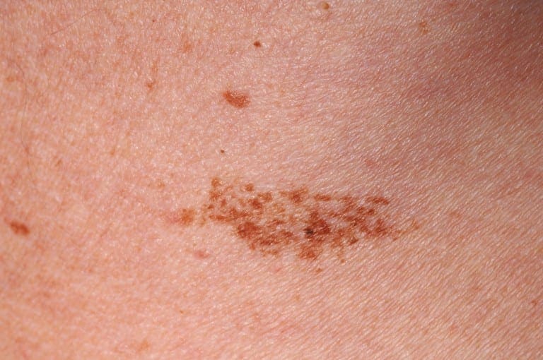 What Is A Nevus Spilus Birthmark?