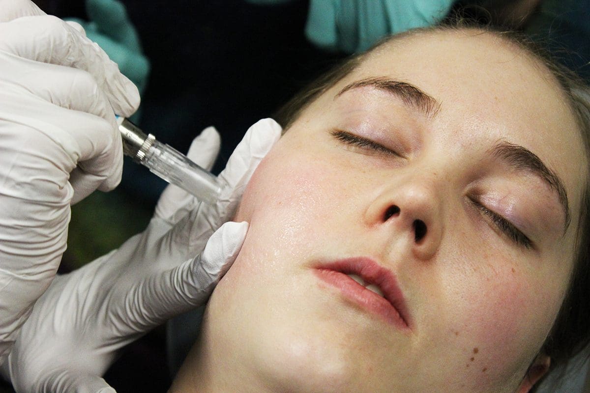 Can You Have Micro-Needling After Dermal Filler?