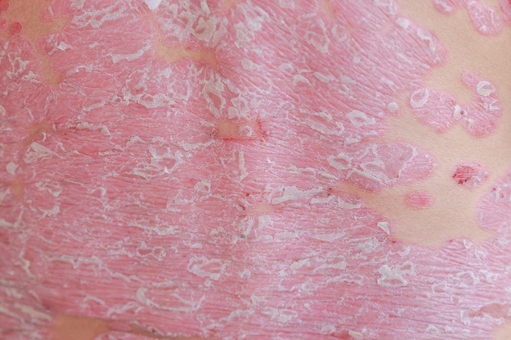 How Pustular Psoriasis and Plaque Psoriasis Differ