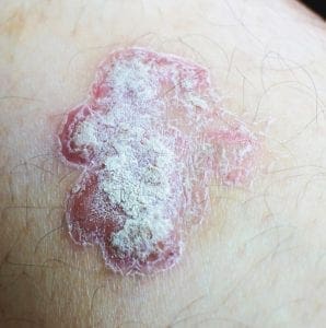 Siliq for the Treatment Of Psoriasis