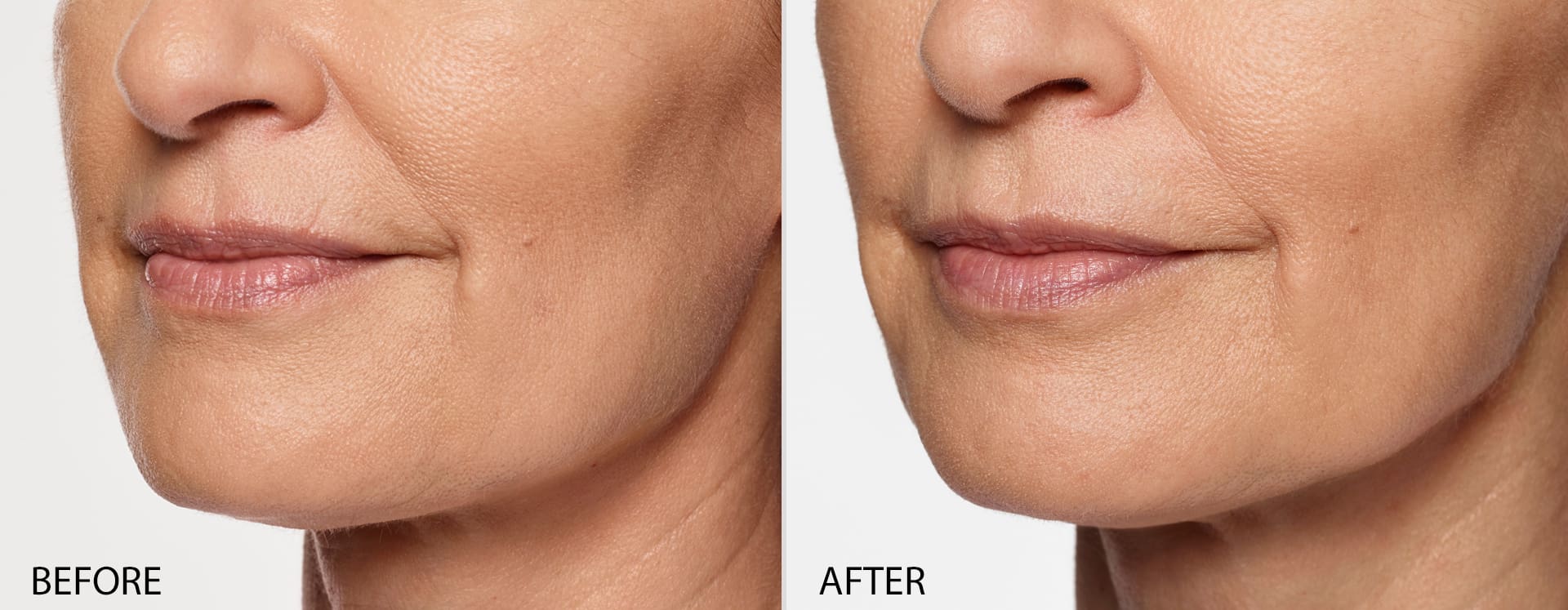 Restylane Silk | Sanova Dermatology