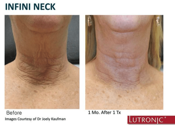 Infini | Sanova Dermatology