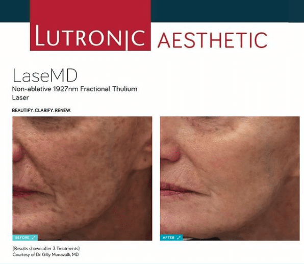 LaseMD | Sanova Dermatology