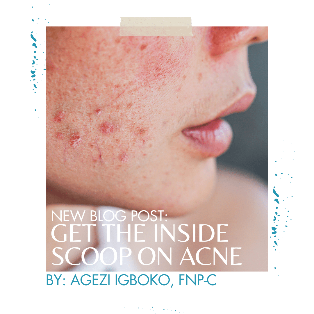 Get the Inside Scoop on the Types of Acne and How to Deal with Them ...