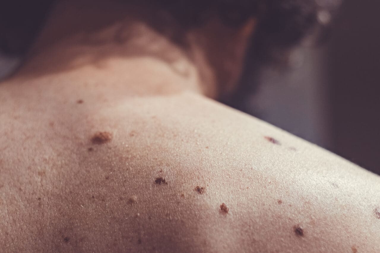 Birthmarks | Sanova Dermatology