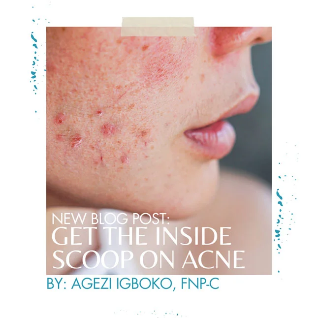 Get the Inside Scoop on the Types of Acne and How to Deal with Them ...