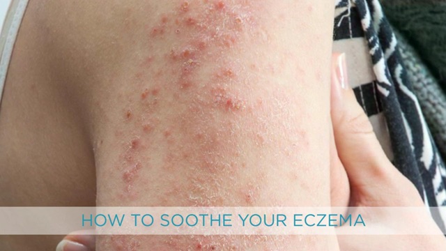 Mild Nummular Eczema